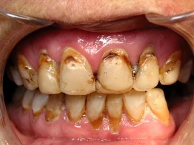 Families Advised To Watch For Meth Mouth
